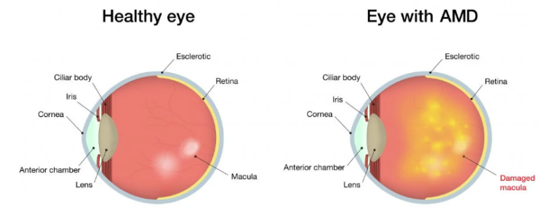 Understanding Age-Related Macular Degeneration: Symptoms and Treatment ...