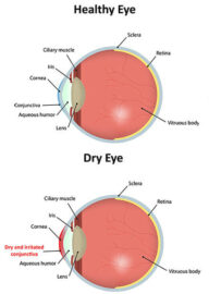 Dry Eye Center Oceanside | Dry Eye Treatment Carlsbad, CA